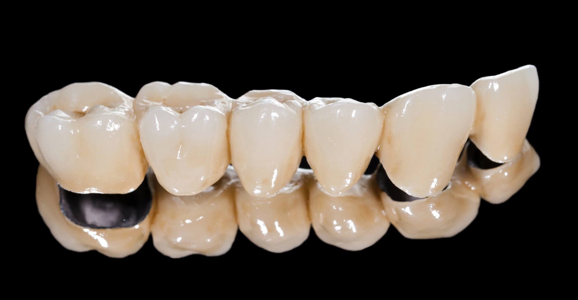 What Happens If a Dental Bridge Falls Out? - Franck Dental